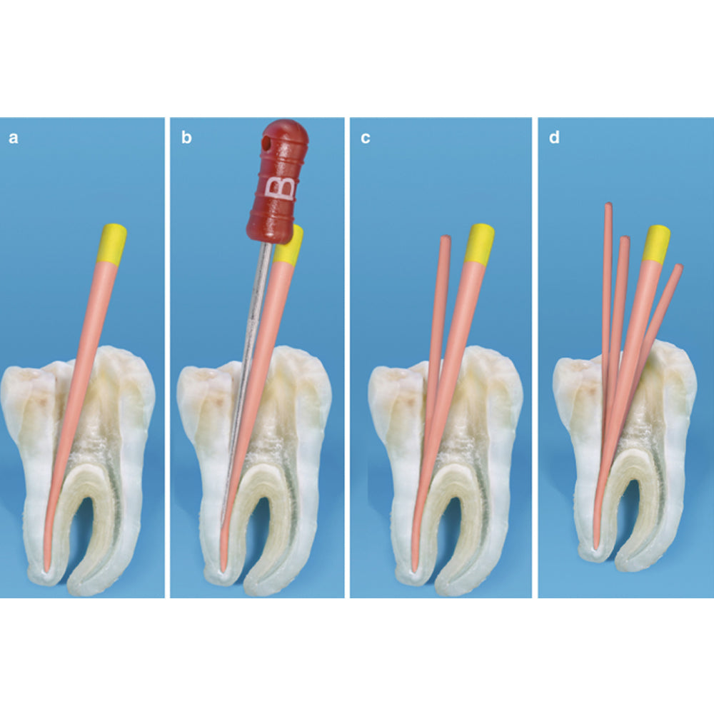 Waldent Finger Spreaders 25mm (Pack of 6) – Waldent.com