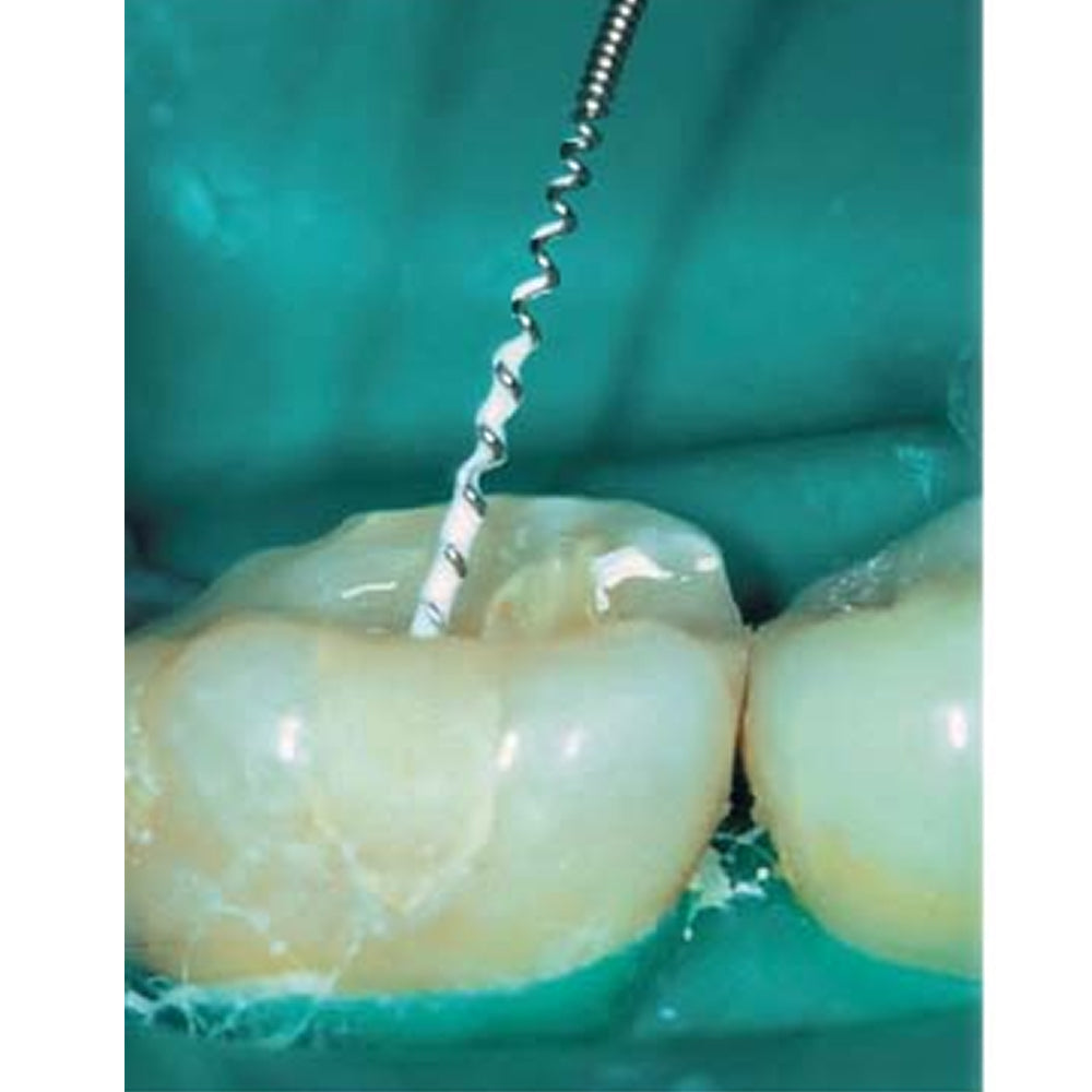 Waldent Paste Carrier (Lentulo Spiral) 25mm (Pack of 4) – Waldent.com