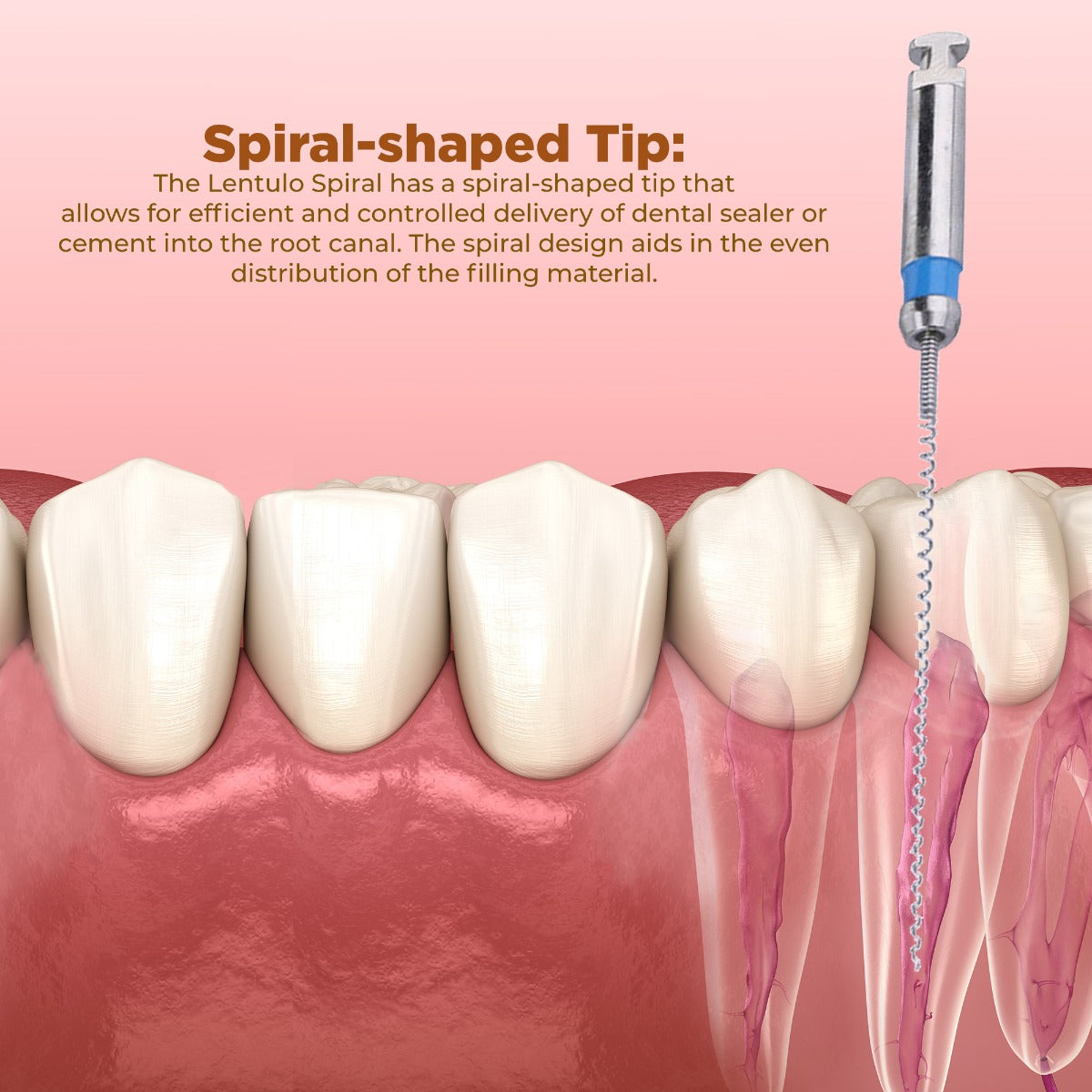 Waldent Paste Carrier (Lentulo Spiral) 25mm (Pack of 4) – Waldent.com